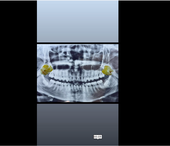 Extracción la muela del Juicio - Trujillo - Clínica Odontológica Nudent ...